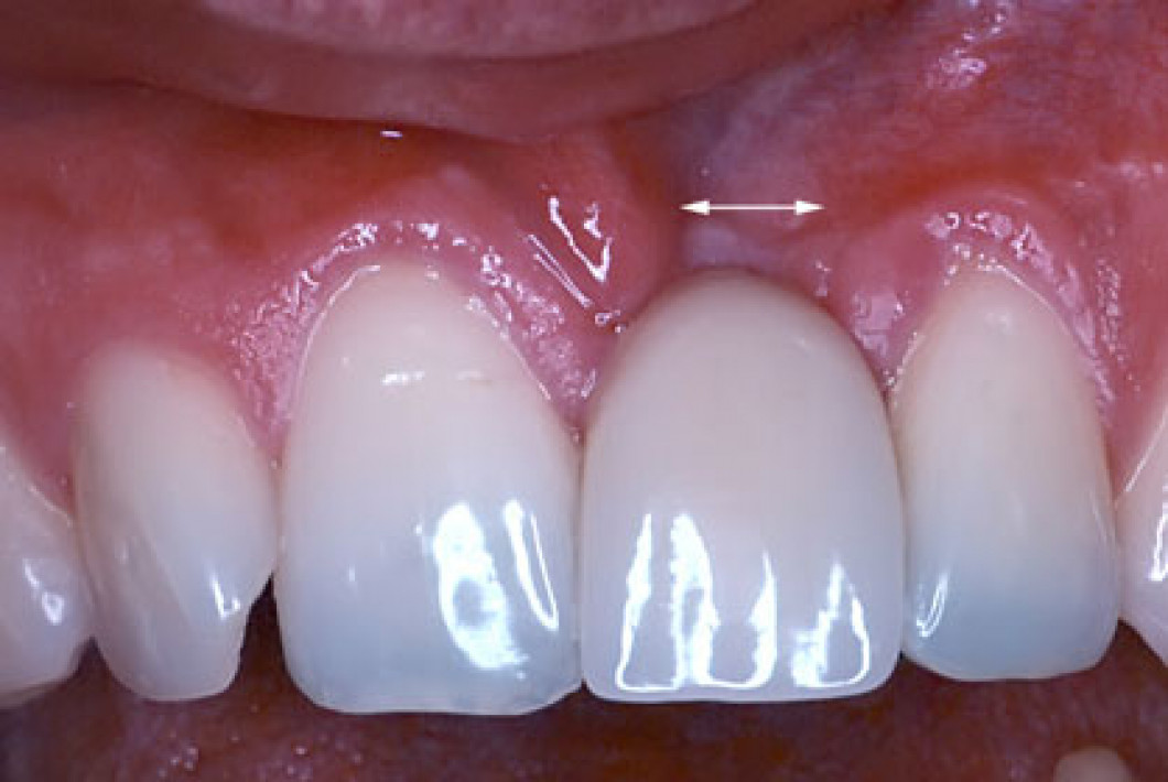 How it Works | New Hartford, Utica, Clinton, NY: Roman S Melnyk DDS, MS