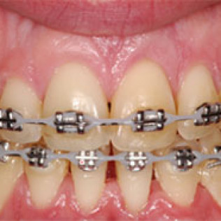 Mucogingival & Gum Recession Treatment | New Hartford, Utica, Clinton ...