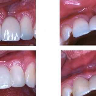 Mucogingival & Gum Recession Treatment | New Hartford, Utica, Clinton ...