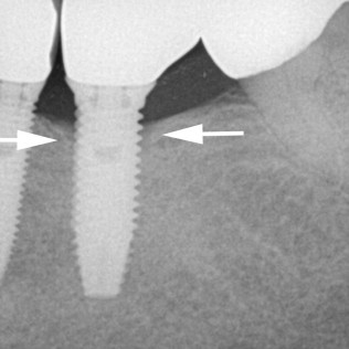 LAPIP & Non Invasive Laser Surgery | New Hartford, Utica, Clinton, NY ...