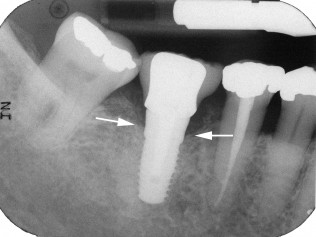 LAPIP & Non Invasive Laser Surgery | New Hartford, Utica, Clinton, NY ...